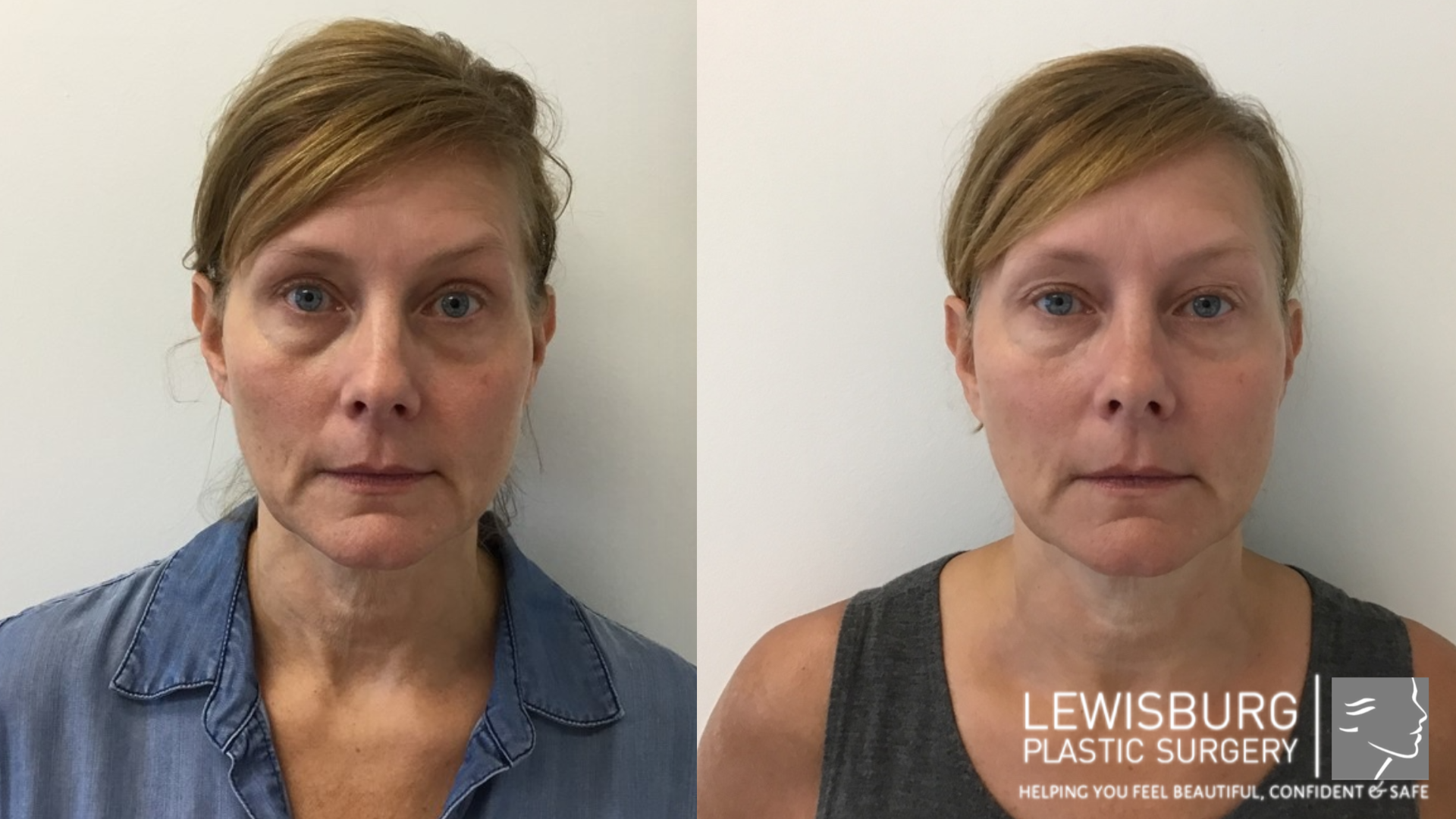 My Microneedling Real Life Before And After Experience